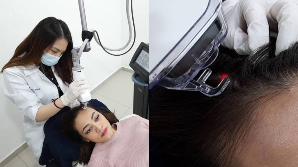 Rawatan Laser Salah Satu Inisiatif Untuk Kepala ‘Togel’ - Santai Sini